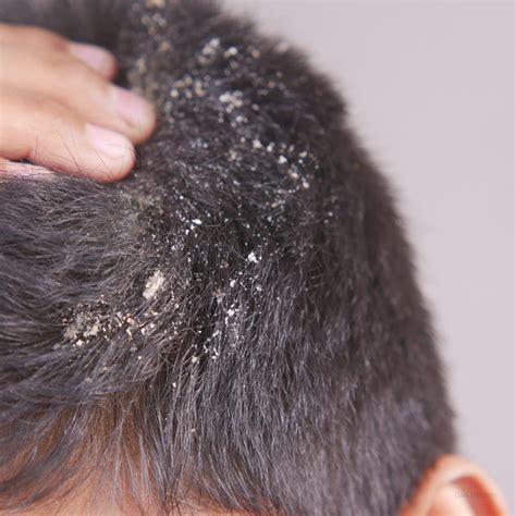 Does Skipping Hair Washes Cause Dandruff Lifestyle By Ps