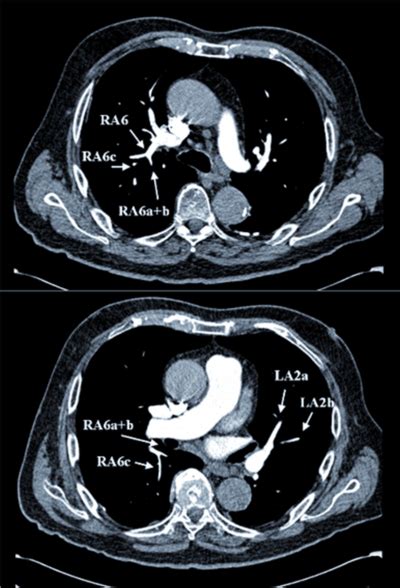 Pulmonary Artery Segmental Anatomy
