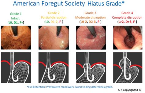 Lower Esophageal Sphincter Endoscopy