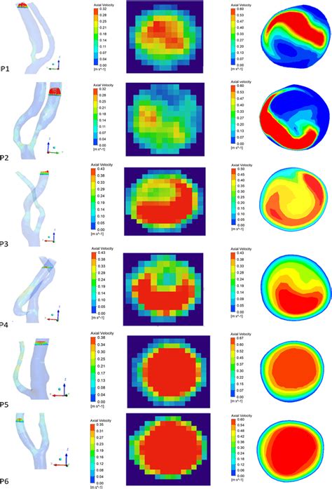 Velocity Comparisons Between Pc Mri Measurements And Cfd Simulations