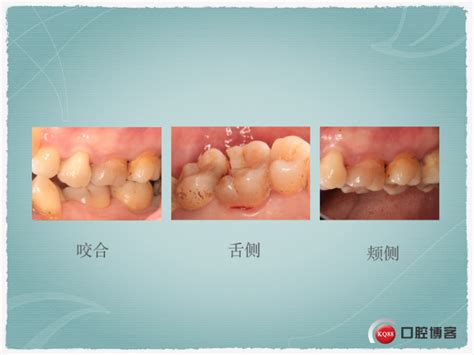 欧罗德卡的魅力MB2根管的快速成形预备 青岛桑冬梅的博客 KQ88口腔博客