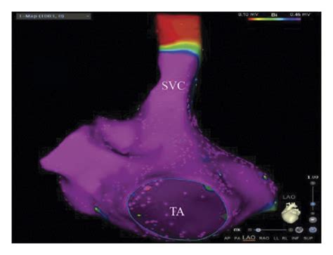 Left Atrial Macroreentry Tachycardia Promoted By Anterior Scar A The Download Scientific