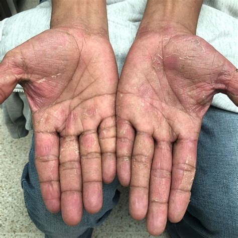 🌿 Fitofotodermatitis Cosecha De Conoce Tu Alergia