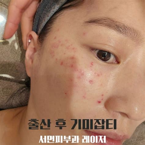 서면피부과 기미잡티레이저 10회 내돈내산 중간후기편평사마귀제거 얼굴 전체 2회 네이버 블로그