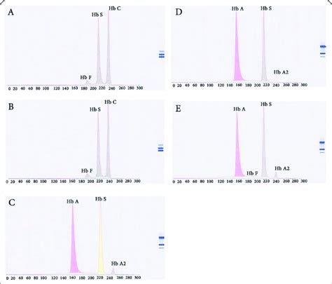 Capillary Zone Electrophoresis A And B S Homozygous Form C D Download Scientific