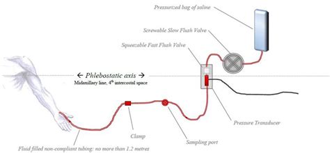 The Arterial Line Pressure Transducer Setup Deranged Physiology Arterial Line Arterial