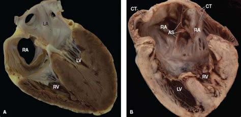 Classification And Terminology Of Cardiovascular Anomalies Thoracic Key