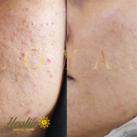 Everything You Need To Know About Laser Acne Scar Removal Healia