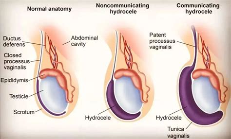 Medical Education Hydrocele A Collection Of Peritoneal Fluid Within The Tunica Vaginalis