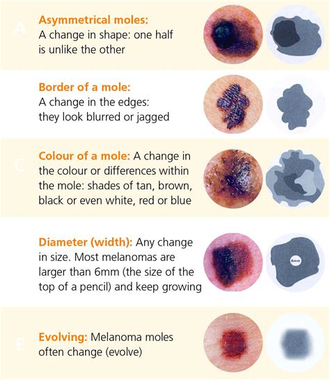 Malignant Melanoma