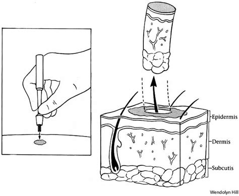 Northland Ear Nose And Throat How To Do A Punch Biopsy