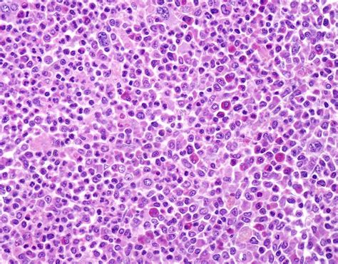 Myeloid Sarcoma Light Micrograph Stock Image C046 8718 Science Photo Library