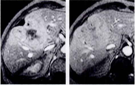 72 Year Old Woman With Peripheral Cholangiocarcinoma A And B Axial