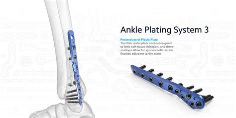 Lateral Malleolar Fracture Solutions Acumed Information