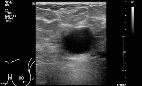 The Radiology Assistant Ultrasound Of The Breast