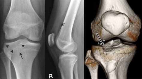 Radiographic Signs Of Type 3a Schatzker Fracture Of Lateral Tibial