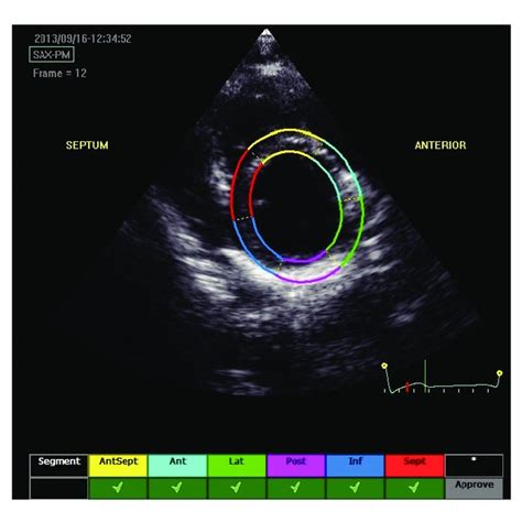 Echocardiograph Shows Segmental Analysis Of The Left Ventricle After 2d Download Scientific