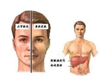 急性无黄疸型肝炎图册 360百科