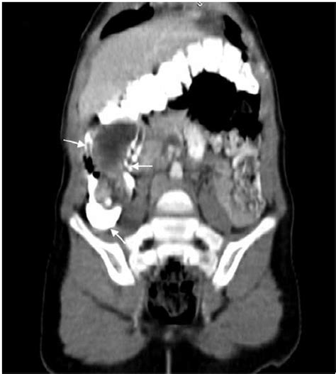 Intussusception And Cecal Duplication Cyst At The Right Upper Quadrant Download Scientific