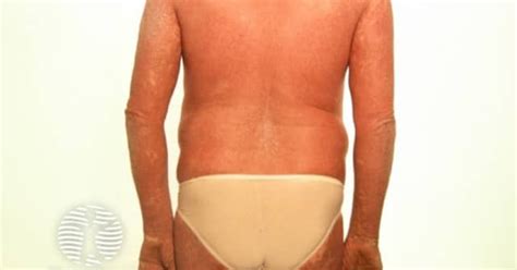 Erythroderma Image