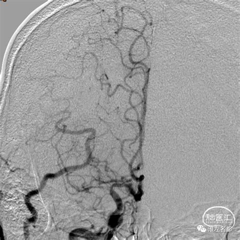 脑血管影像案例（39）：发作性偏身不自主运动和青年mca狭窄 脑医汇