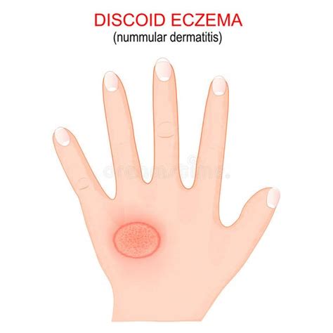 Discoid Eczema Stock Illustrations 7 Discoid Eczema Stock