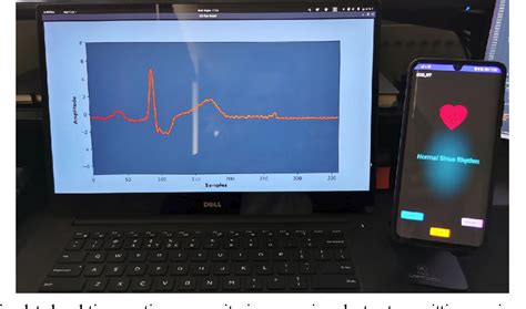 Figure 1 From Ecg Based Real Time Arrhythmia Monitoring Using Quantized