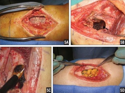 Osteomylitispptx Free Download