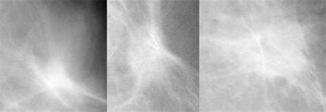 Abnormality Detection In Mammography Using Deep Convolutional Neural Networks