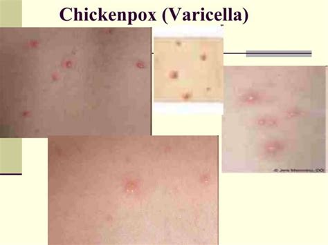 Exanthemapresentation Infectionsdiseasesppt