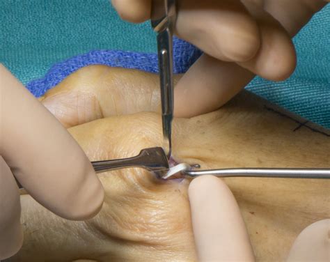 Technique Eip To Epl Tendon Transfer Luanmd Technique Eip To Epl Tendon Transfer Luanmd