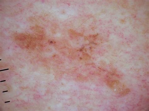 Ensemble Of Convolutional Neural Networks For Dermoscopic Images Classification Deepai