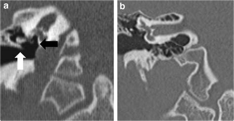 Downward Oval Window And Horizontally Orientated Scutum In The Same