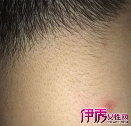 脖子下面淋巴结肿大图脖子下面淋巴结肿大该怎么办 向你推荐其有效的治疗方法 伊秀健康 yxlady