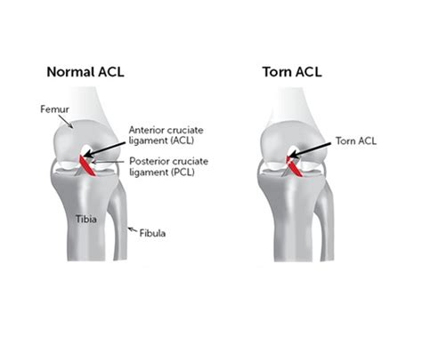 So What Is The Acl Fit2function Clinics So What Is The Acl Fit2function Clinics