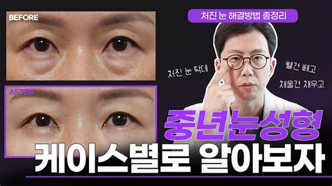 [중년 눈성형] 처진 눈 개선하는 중년 눈성형 증상별 수술 방법과 전후 변화까지 한 방에 확인하기👀 그레이스성형외과 상안검 눈썹거상 눈매교정 지방이식 Youtube