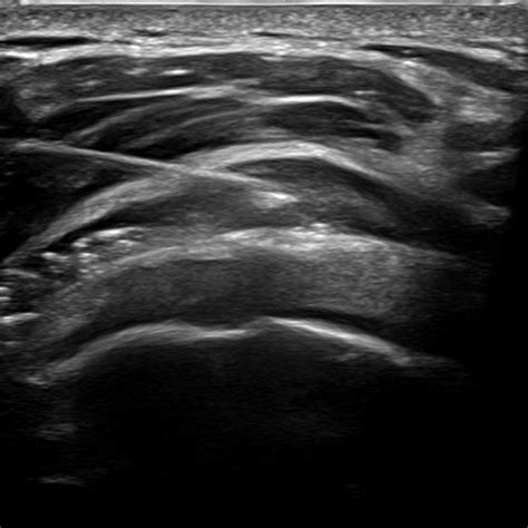Subacromial Injection Subacromial Shoulder Injection Ultrasound