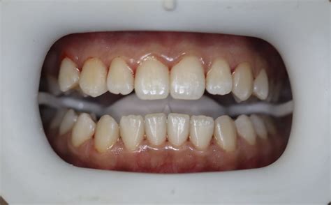 Teeth Whitening Before And After The Gentle Dentist