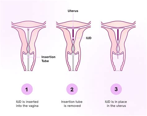 What It Feels Like To Get An Iud Natural Cycles