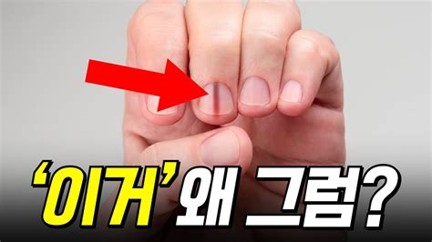 손톱에 검은 세로줄이 생겼나요 Youtube