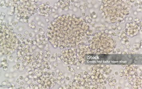 Pyuria Or Leukocyturia Is The Condition Of Urine Containing White Blood