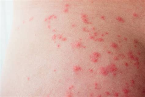 Neutrofilija Diagnozė Priežastys Simptomai Ir Esmė