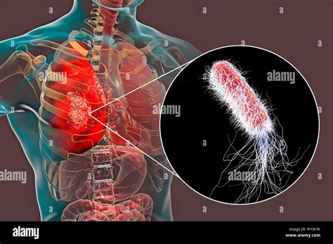Wound Infection Pseudomonas Aeruginosa At Amy Ammerman Blog