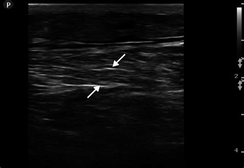 Ultrasound Image In D Of The Left Rectus Femoris Muscle Showing Download Scientific Diagram