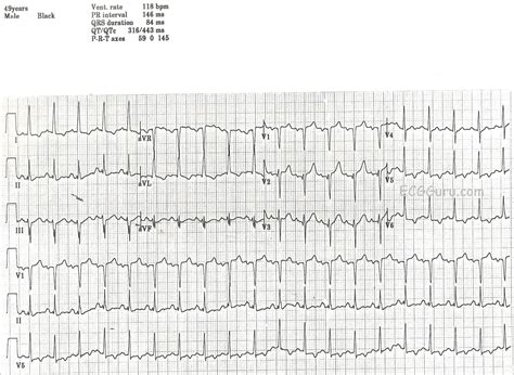Inverted T Waves In Lateral Wall Ecg Guru Instructor Resources
