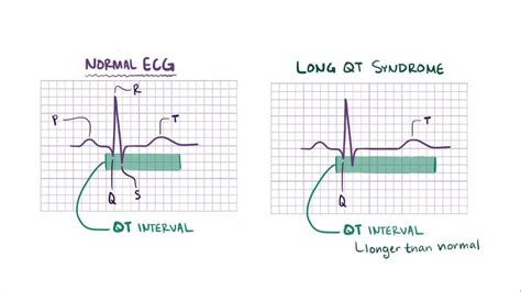 Long Qt Syndrome And Torsade De Pointes Video Osmosis