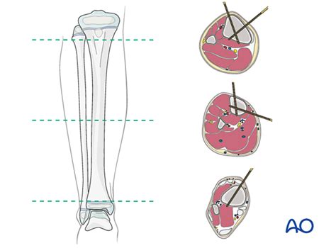 External Fixation For Simple Oblique Or Spiral Tibial Fracture