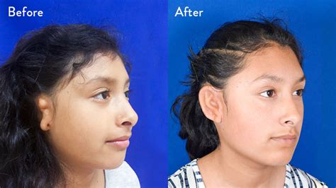 9 Year Old Female With Right Grade 2 Microtia Before And After Rib