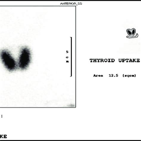 Radioisotope Thyroid Scan Showing Abnormally High Thyroid Uptake