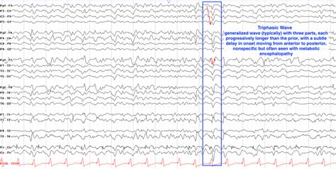 Slowing And Other Non Epileptiform Abnormalities
